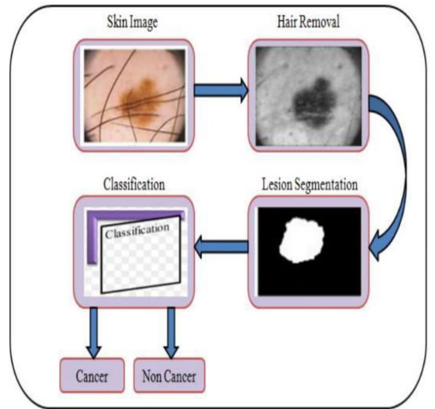 General steps for skin cancer recognition system the
