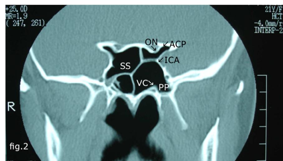 A coronal ct scan of the head region of a female aged 21