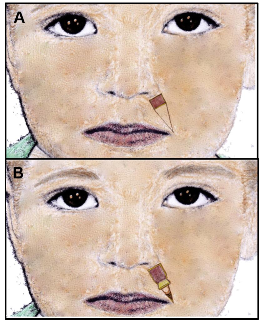 (a) creation of the revised primary defect. incision on the