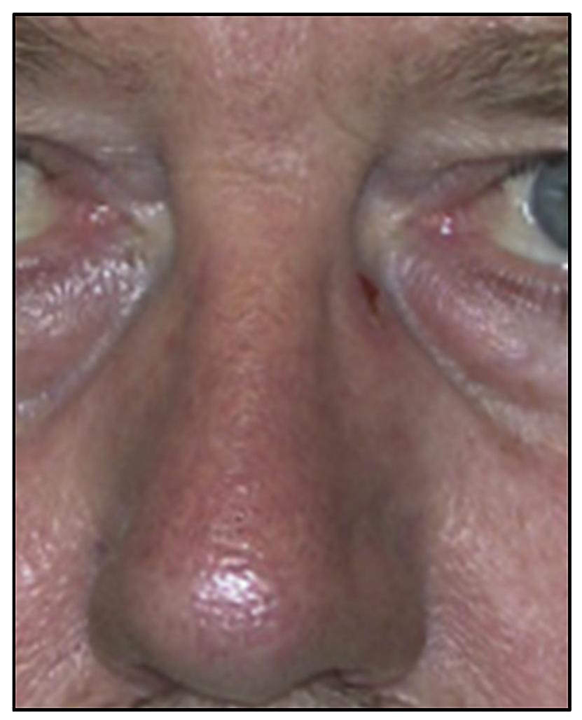 60-year old man with a biopsy-proven basal cell carcinoma on