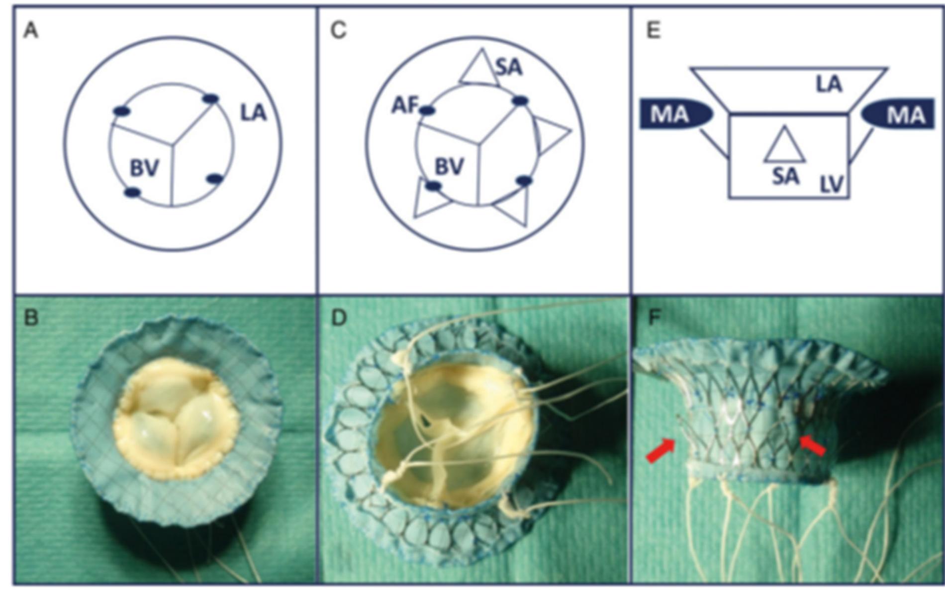 Illustration of the mitral valved stent prototypes with