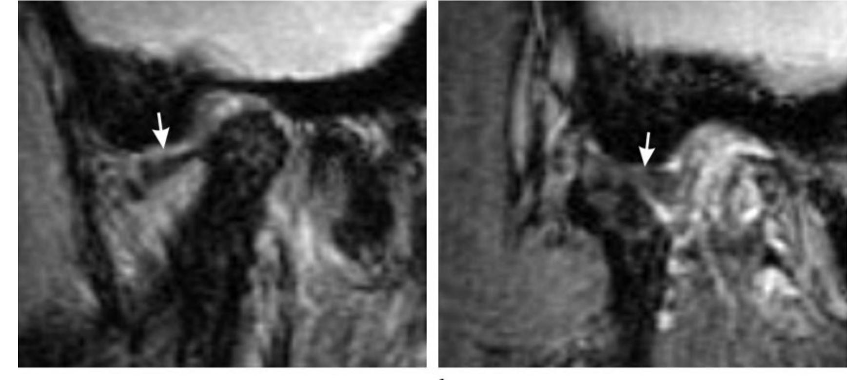 Anterior disk displacement with reduction. (a) sagittal
