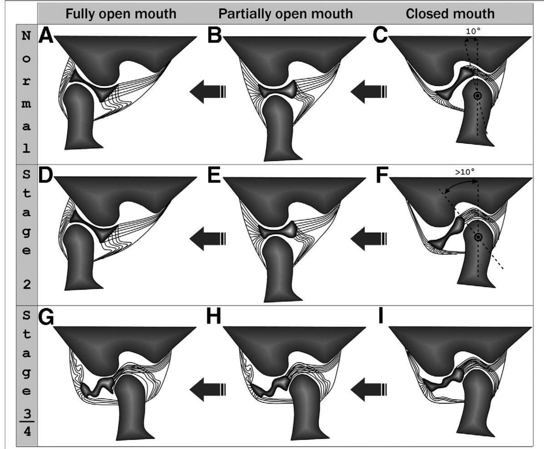 Schematic representation of disc position and morphology