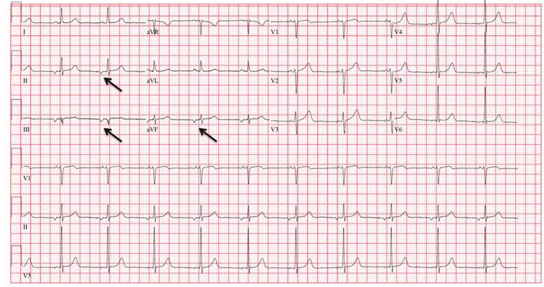 Ecg shows an ectopic atrial rhythm. the atrial rate is 63