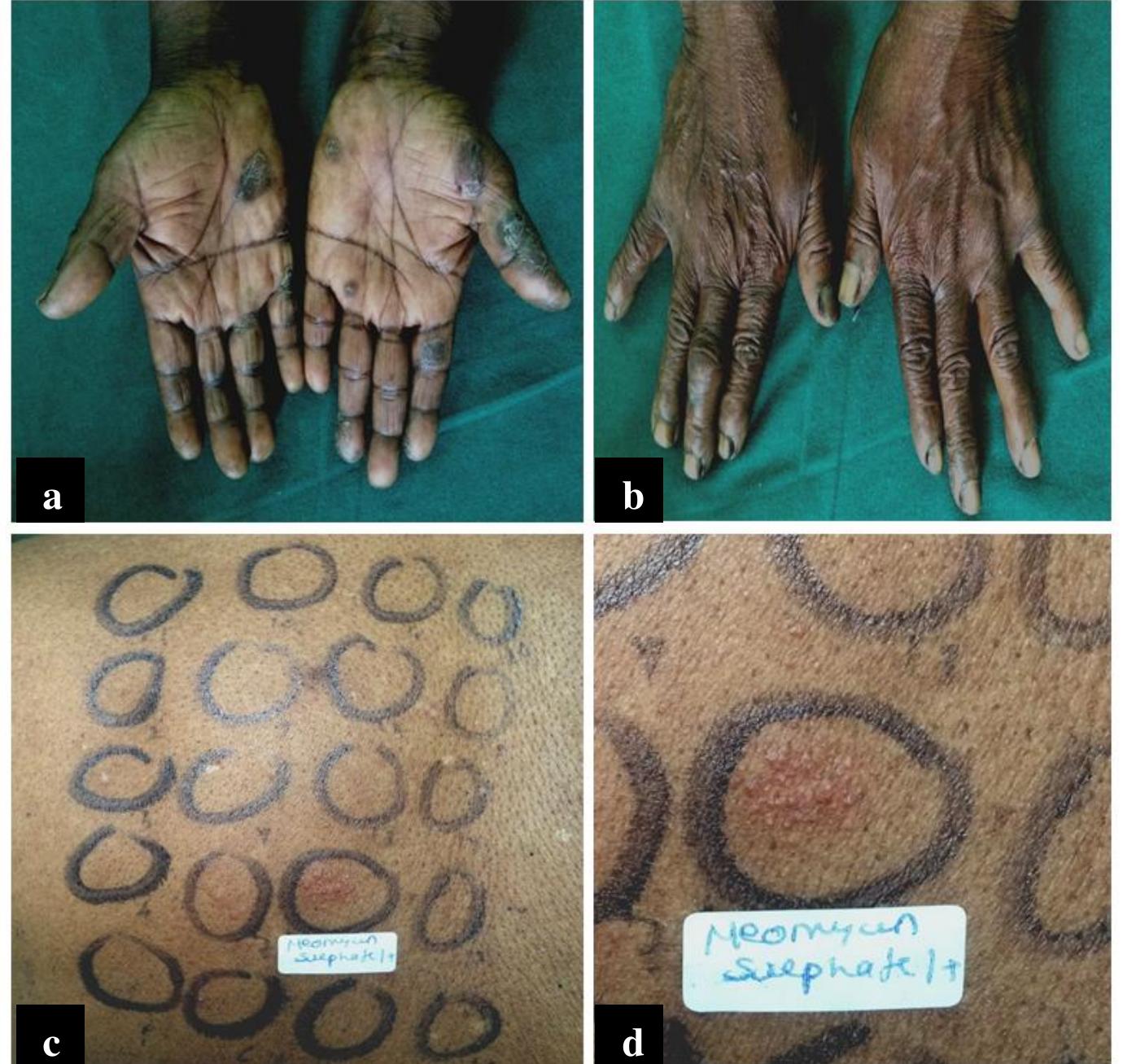 Patient with hyperkeratotic eczema. (a,b) multiple