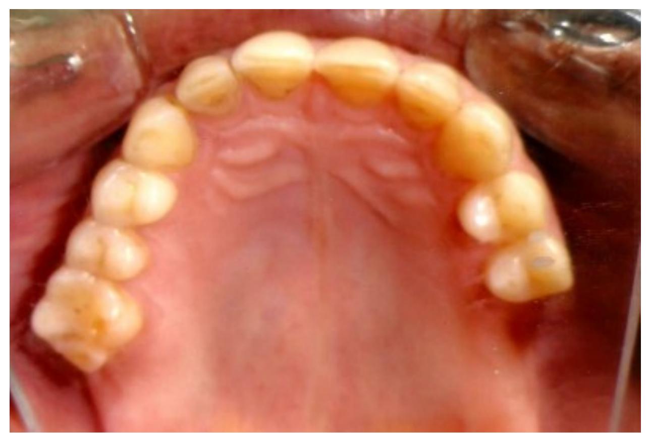 Intra oral view of maxillary partially edentulous arch