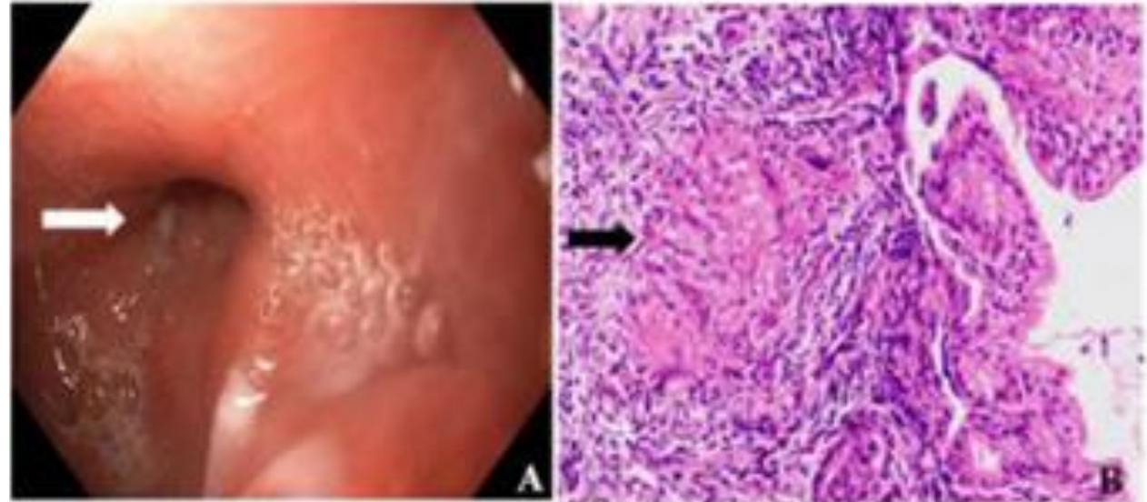 Endoscopy showing distorted pylorus with ulceration in