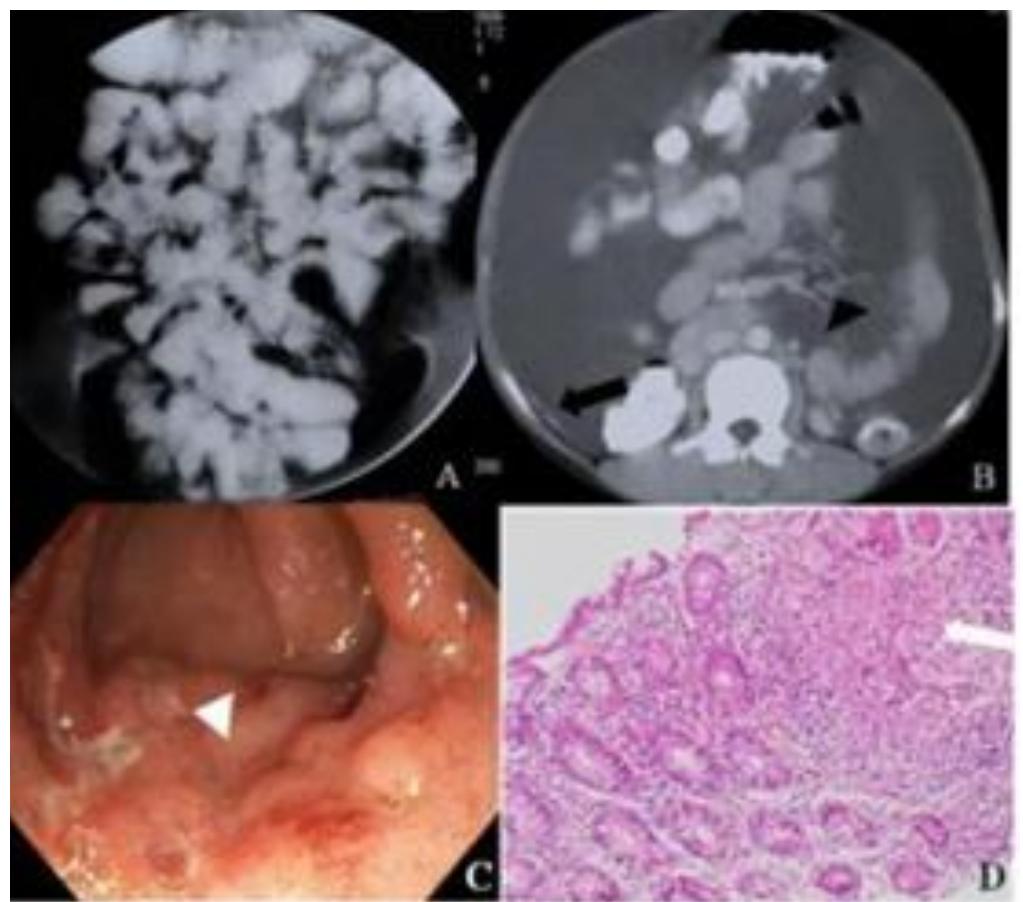 A. barium meal follow through showing clumping of bowel