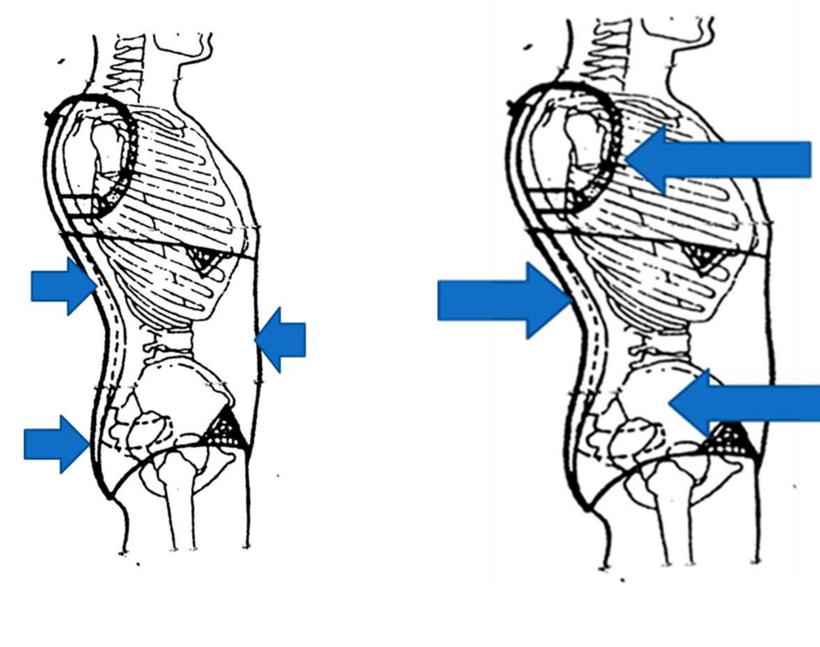 ¢ Controls Flexion Extension Applying 3 Point Force System