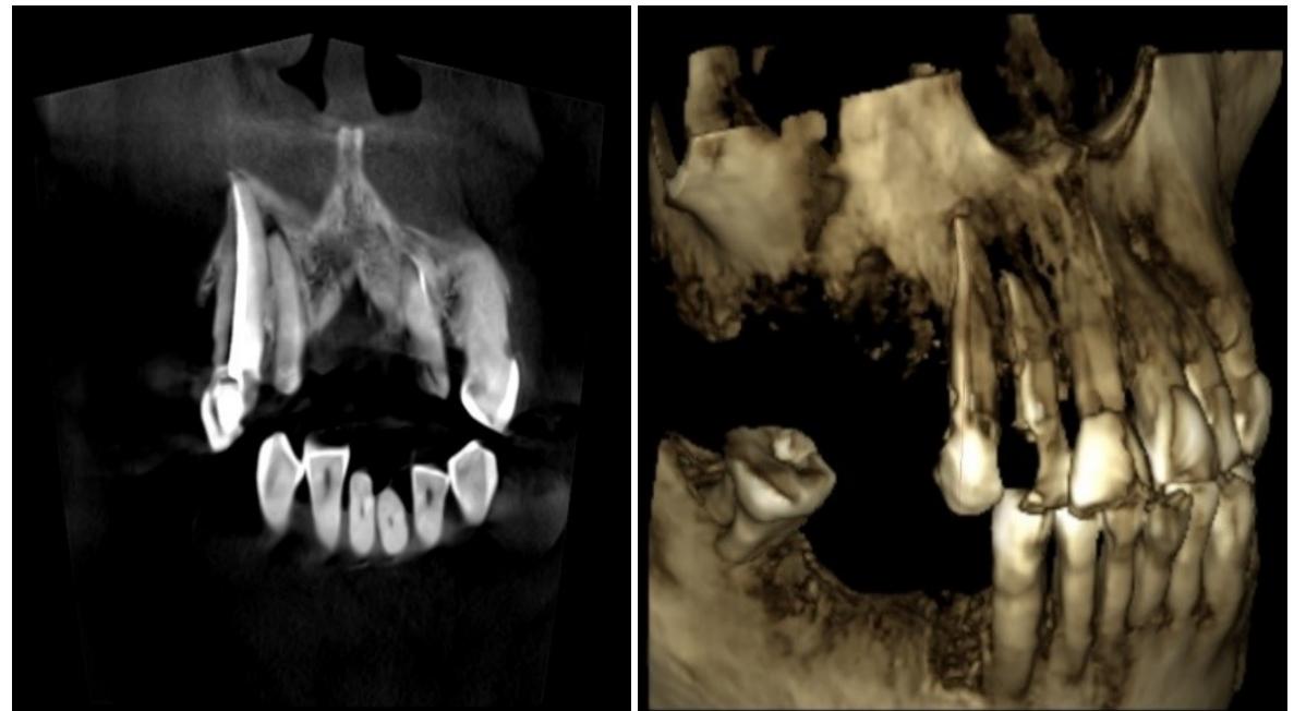 A&b views of cbct six months follw up, full hermatic