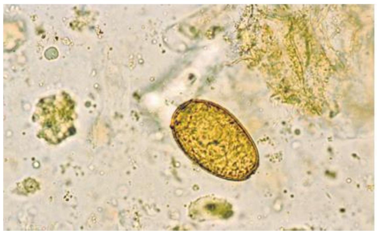 Paragonimus westermani ova. (image from clinical