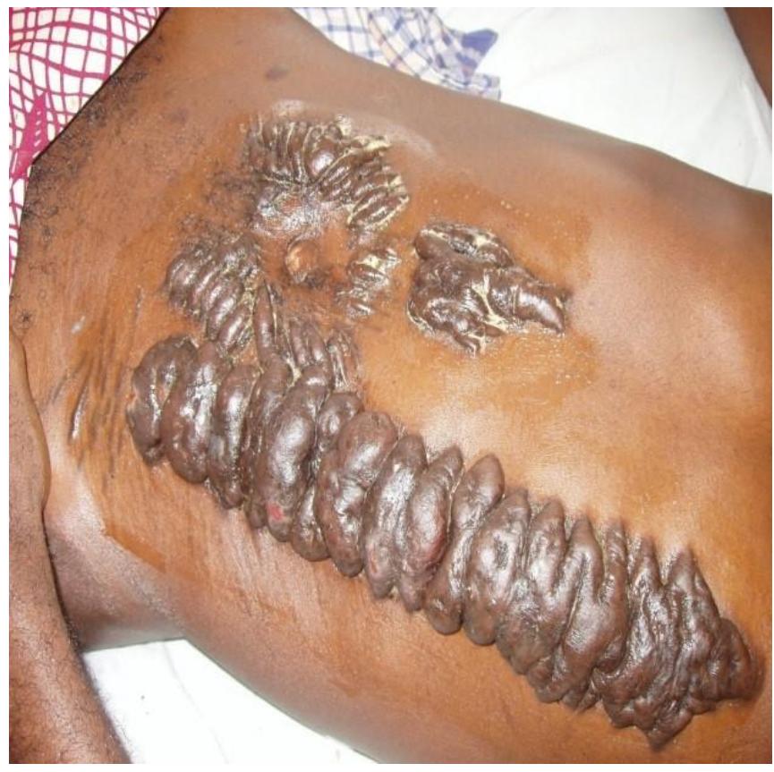 Established keloidal scar complicating abdominal