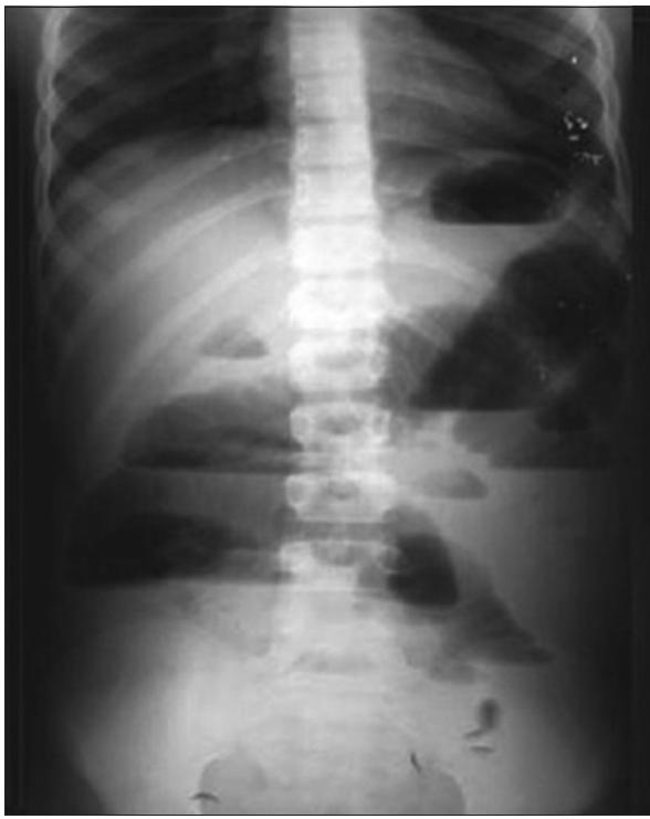 |: plain x-ray abdomen erect posterior-anterior view shows