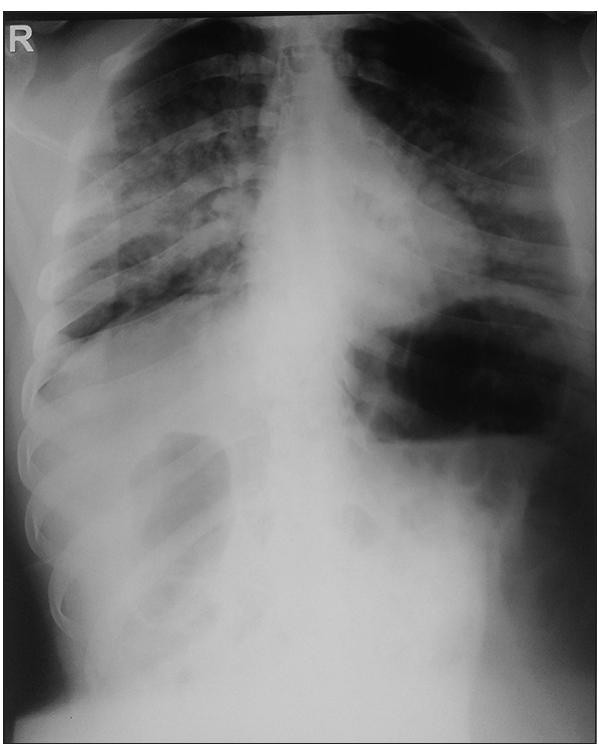 Bedside supine x-ray chest anterior-posterior view shows