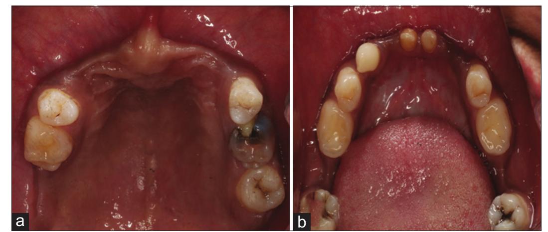 (a) intraoral occlusal view of maxillary arch depicting