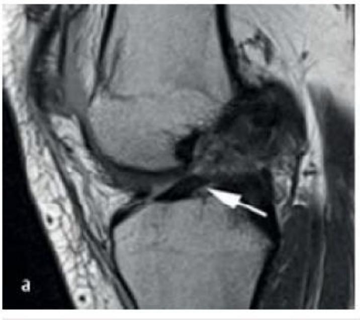 Gambar | : sagital mri knee pasien dengan acute tear acl
