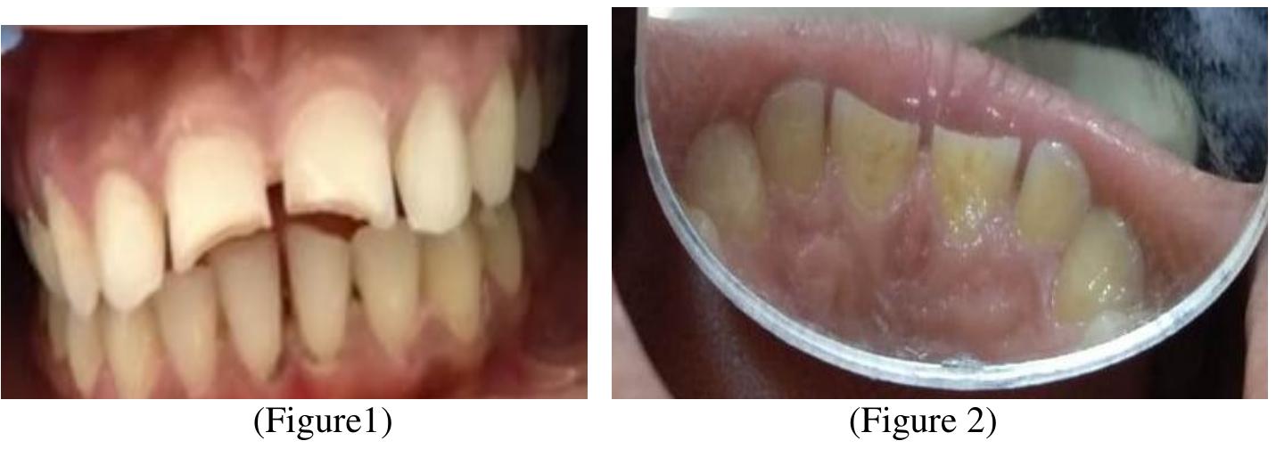 Anterior esthetic restorations, the putty index technique —a