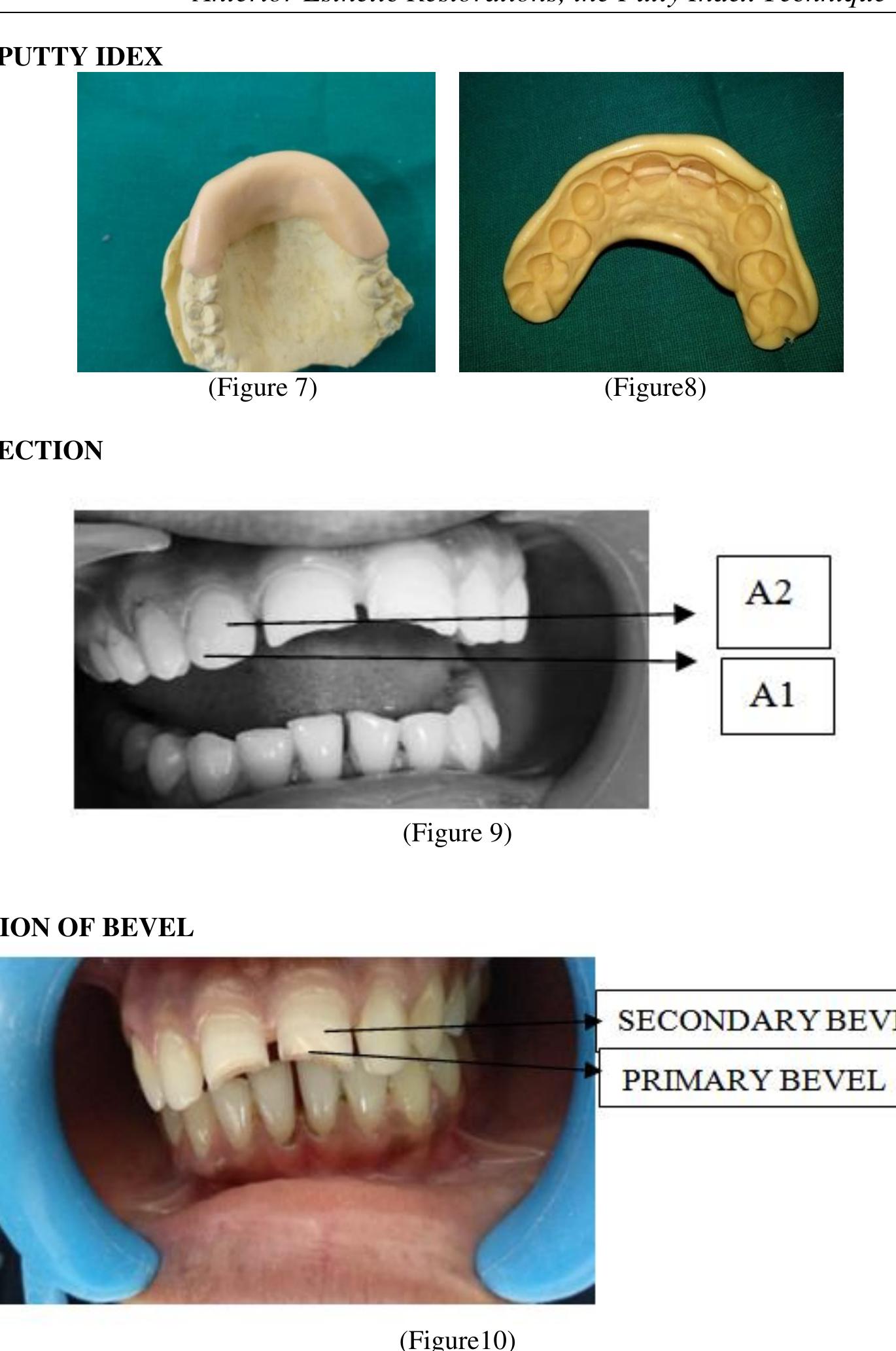 Figure 3 - Anterior Esthetic Restorations, the Putty Index