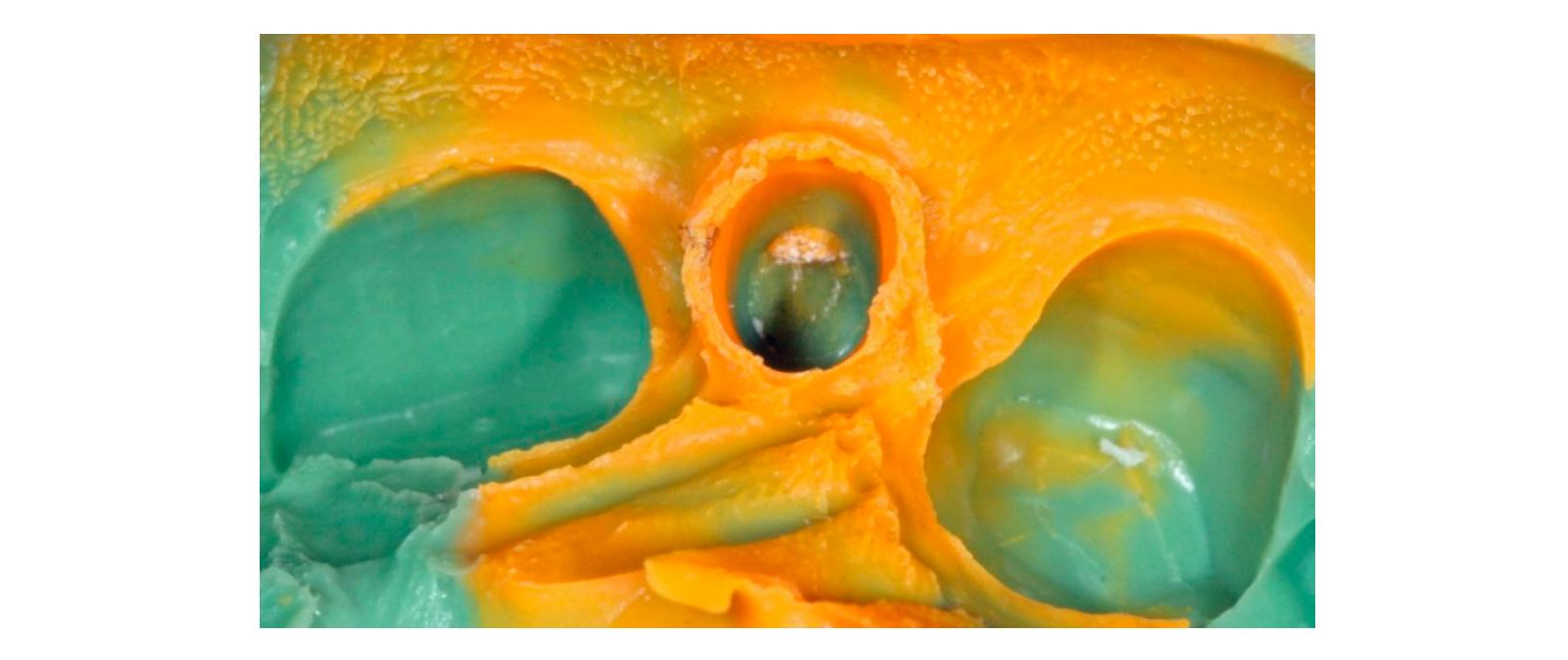 Abutment level impression as conventional crown and bridge