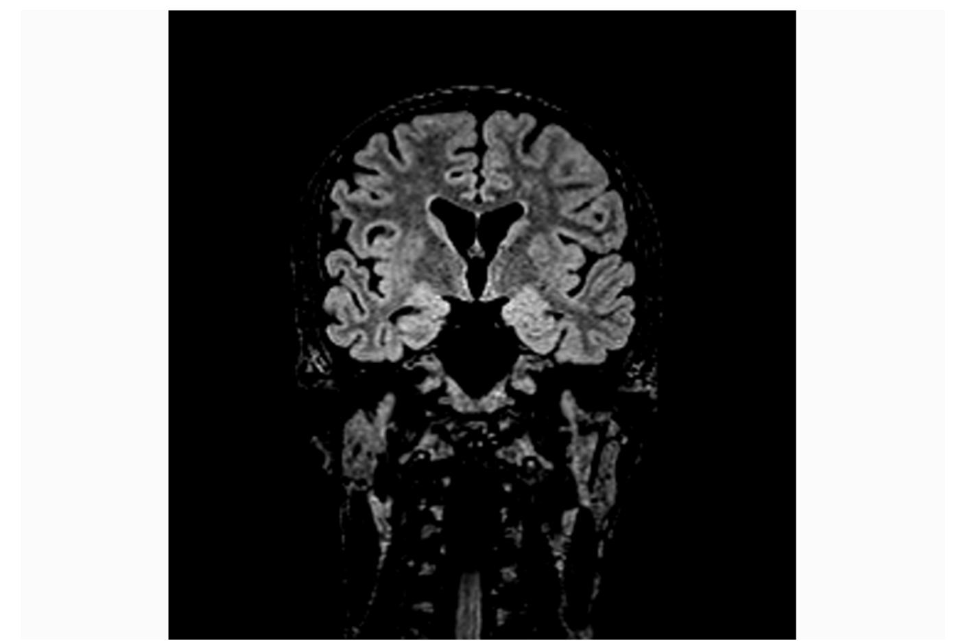 Hive. mri (t2-w flair) coronal section: mild