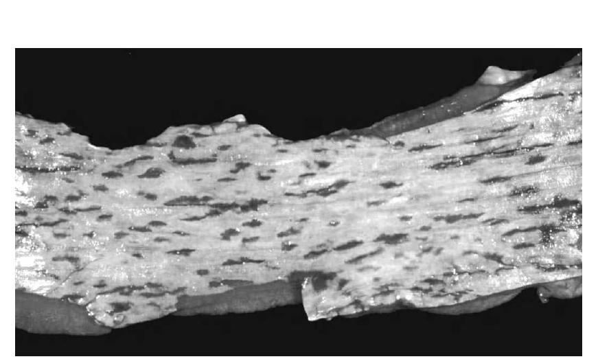10. postmortem image of esophageal ulcers and erosions in
