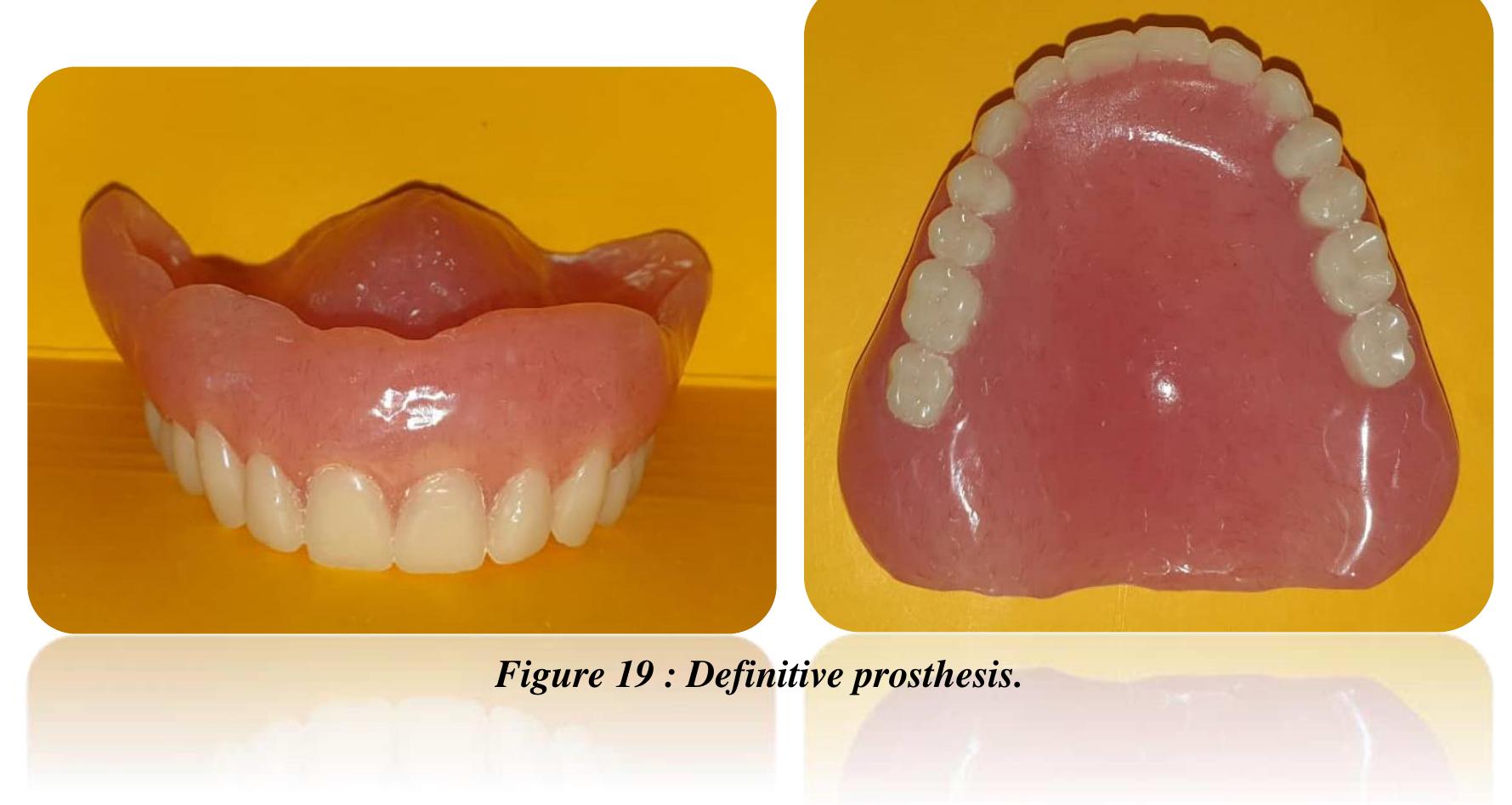 Surgical phase — a“ extraction of the maxillary teeth