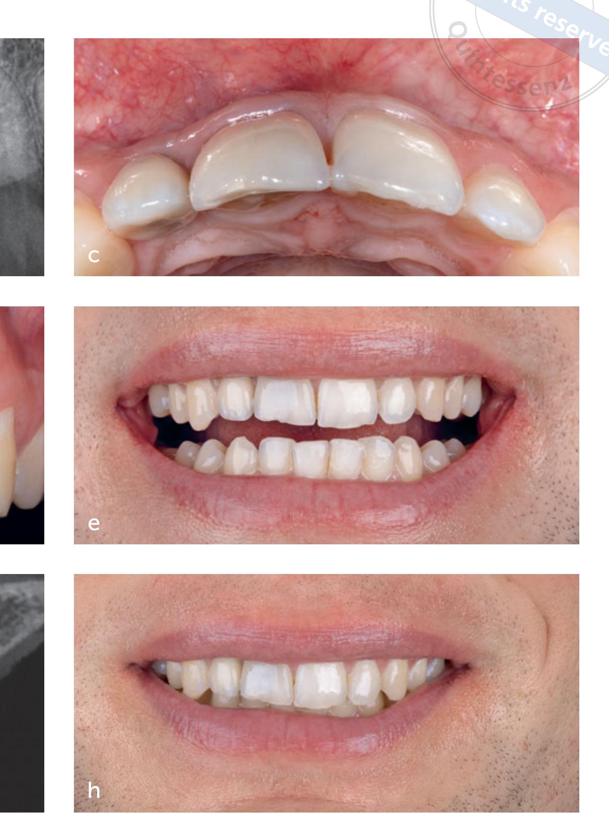 Figure 7 - A decade of the socket-shield technique: a
