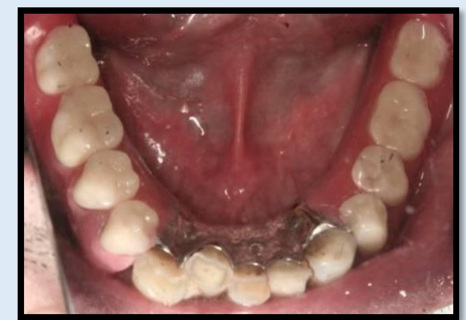 Try in —occlusal view. figure 17: try-in inpatient mouth.