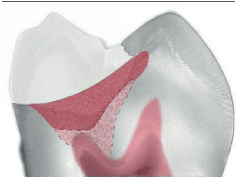 Deep caries lesion showing the outer carious dentin staining