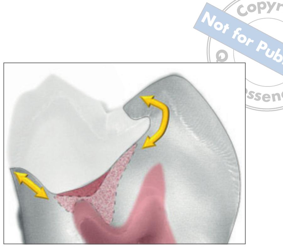 Caries removal end points for a deep lesion. the peripheral