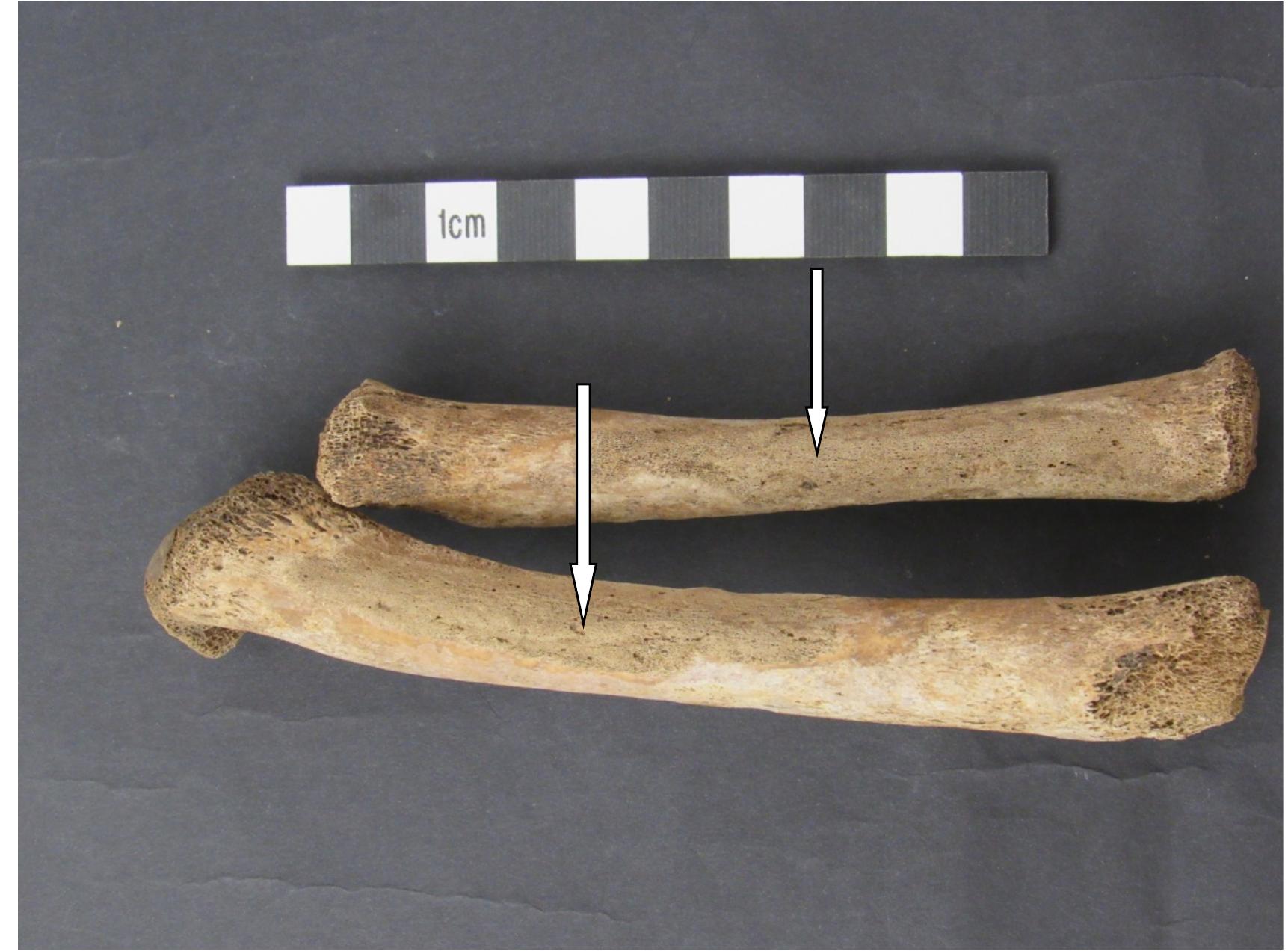 Plate 12. periosteal lesions on the left femur and right