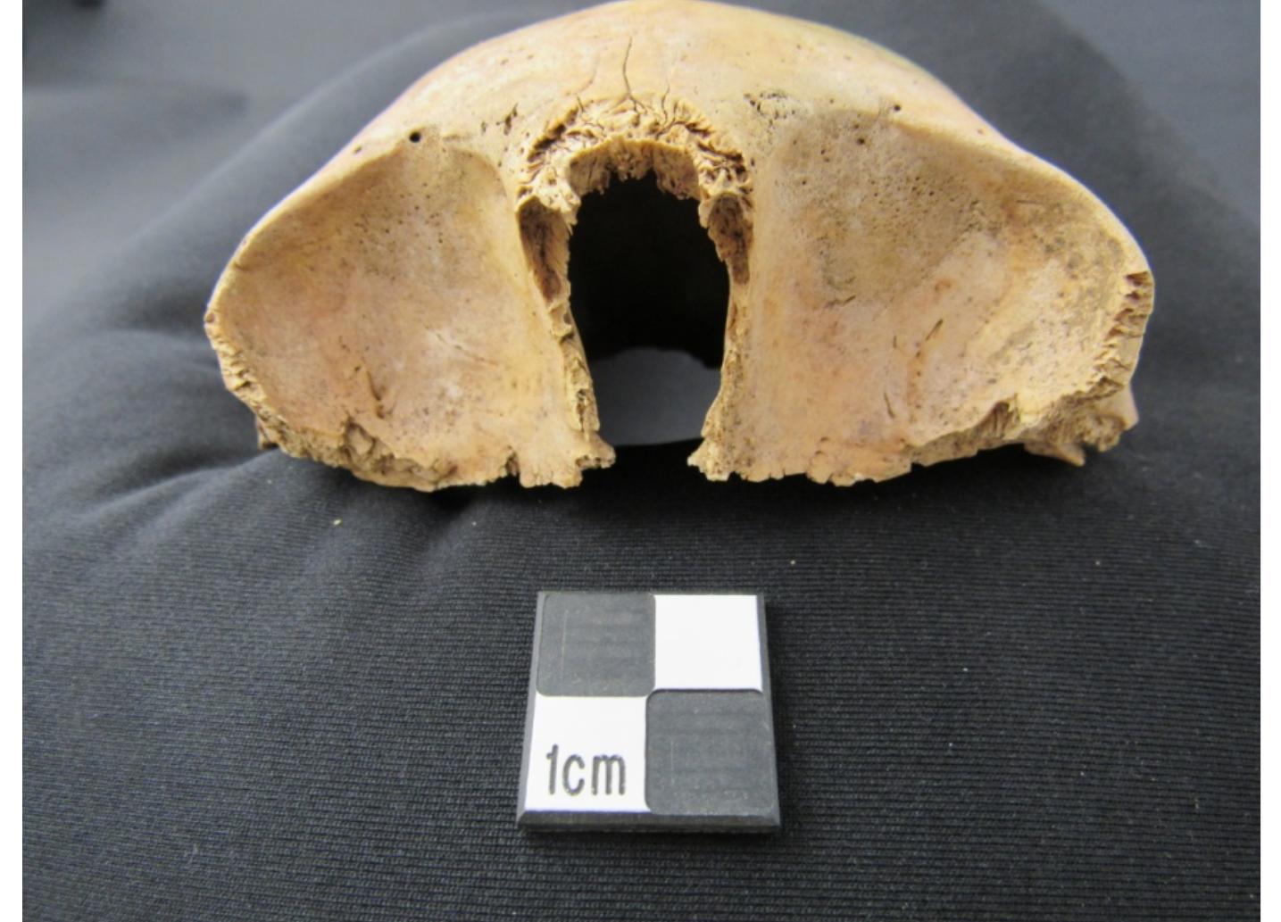 Plate 13. cribra orbitalia in the upper central areas of the