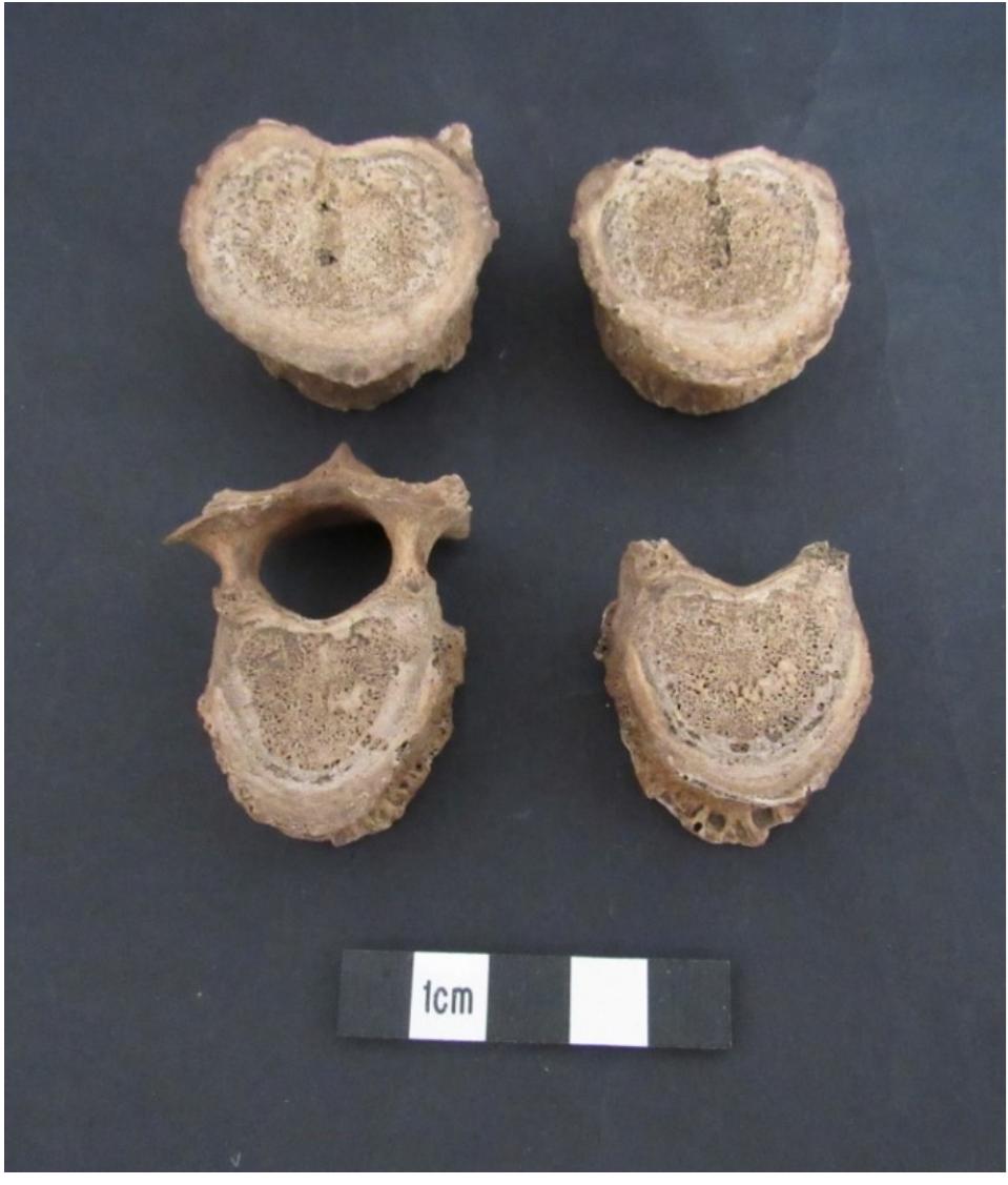 Plate 15. spondylosis (lipping) on thoracic vertebra of sk.