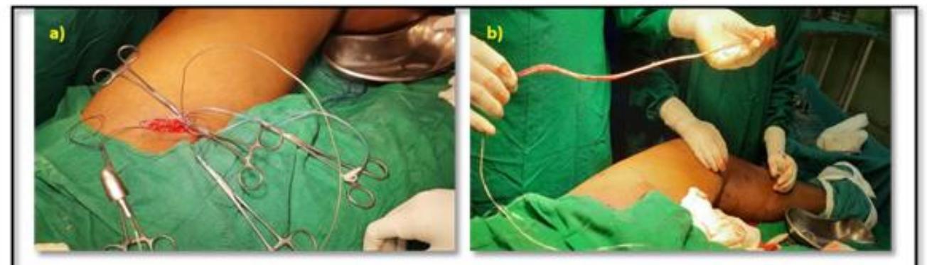 Trendelenburg procedure: a)trendelenburg procedure b) great