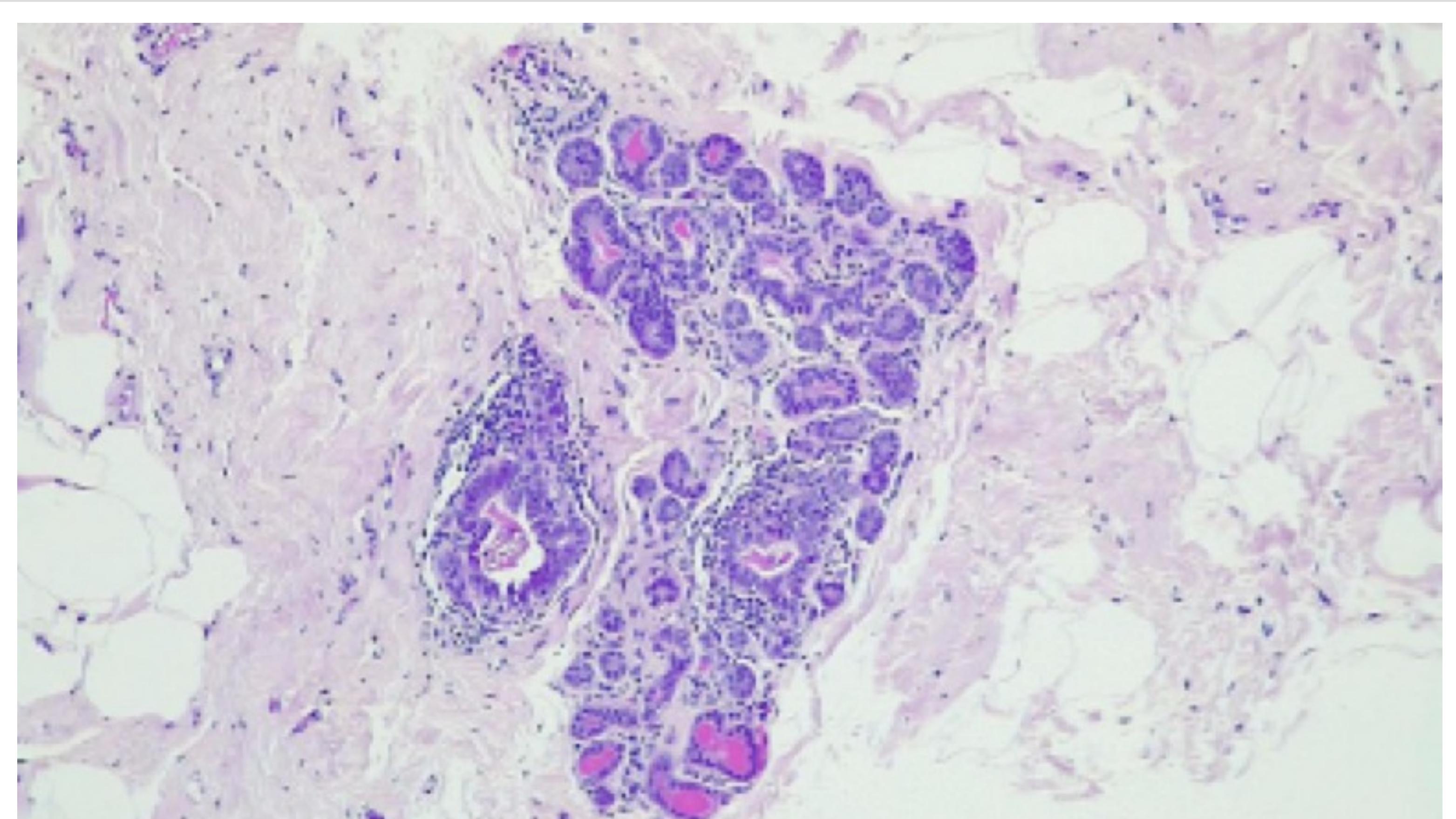 Histologic examination of the specimen submitted confirms