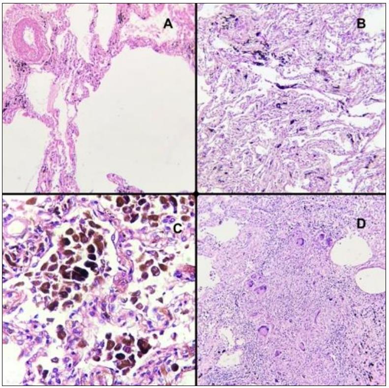 Emphysema [a]: showing dilatation of the alveoli.