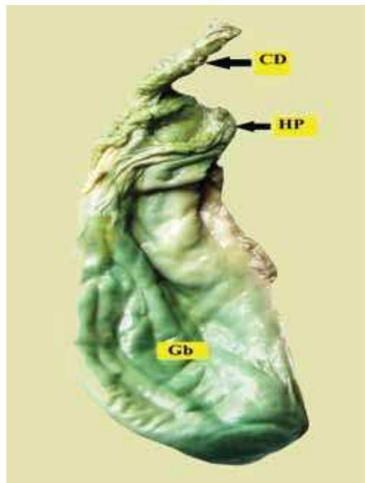 (PDF) Study of Hartmann’s Pouch of the Gallbladder
