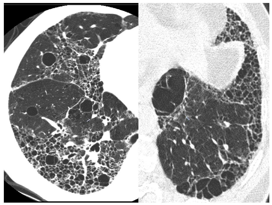 - honeycombing. lower lobe predominance, with cysts of