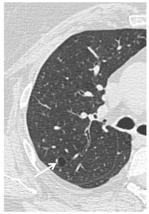 - incidental cyst. these cysts can occur in any lobe of the