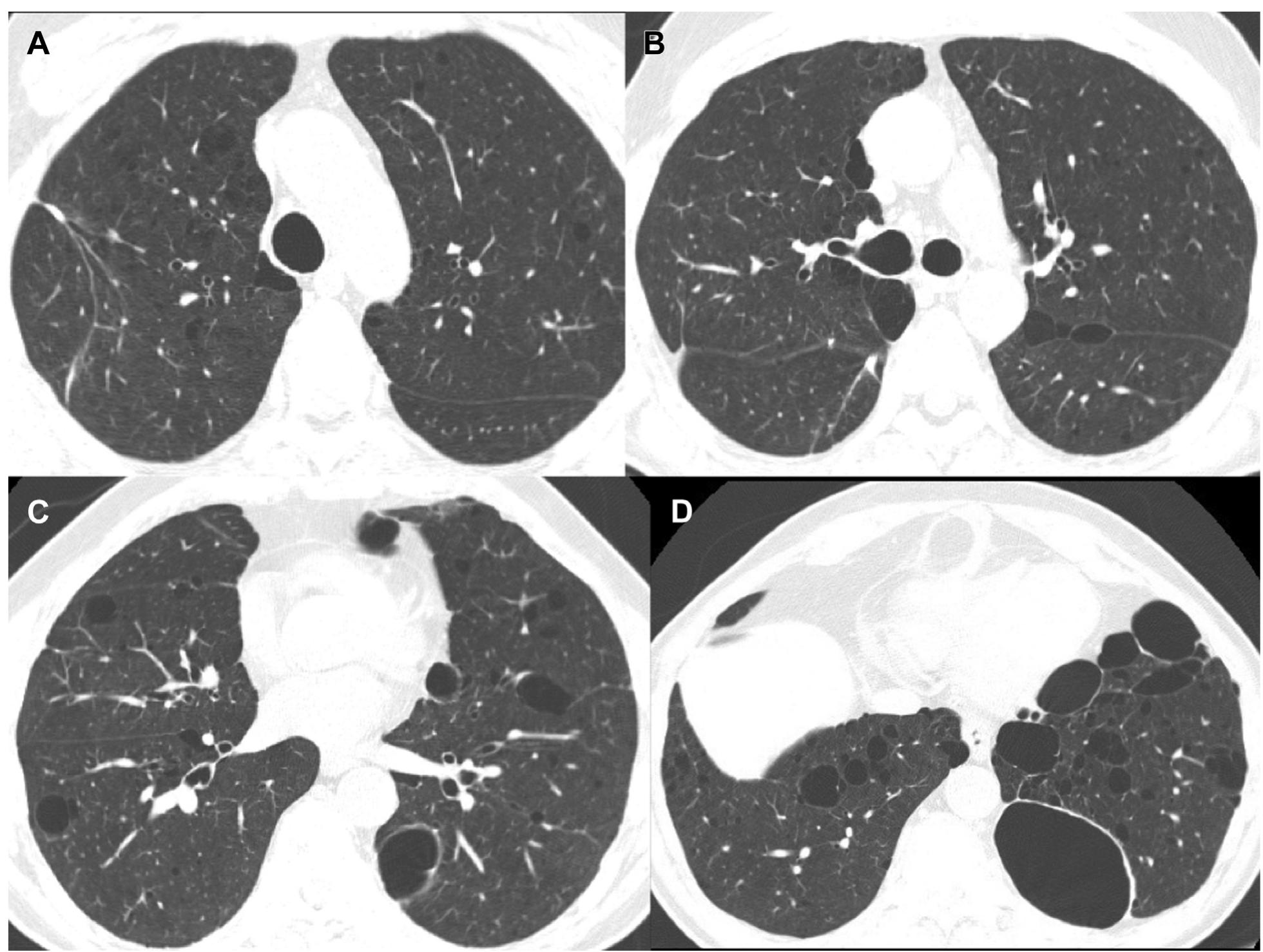 - a-d, axial ct chest images of a patient with