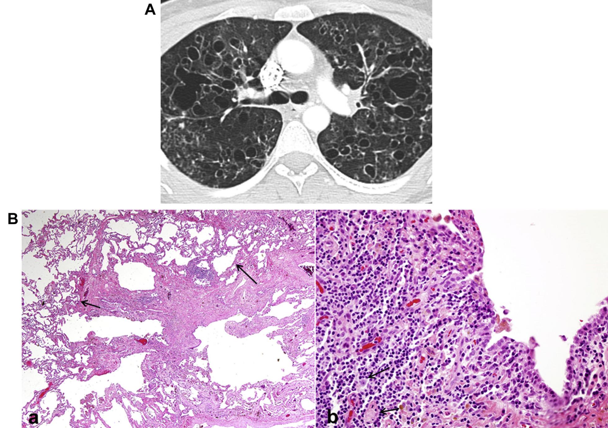 - a, pulmonary langerhans cell histiocytosis. generally seen