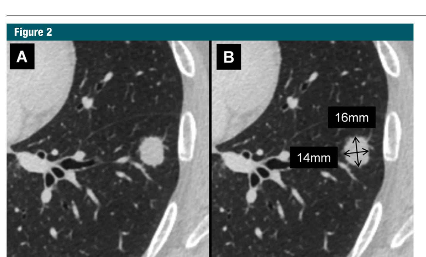 Transverse ct sections of a solid nodule in the left lower