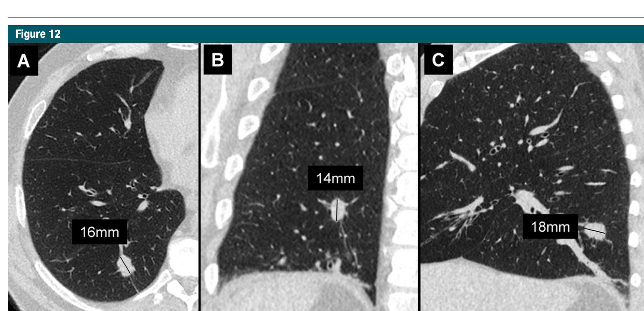 A, transverse, b, coronal, and, c, sagittal reconstruction