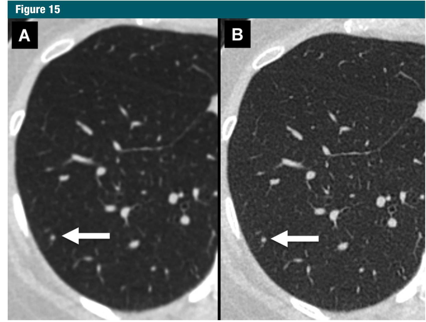 Transverse ct sections through a small nodule in the right