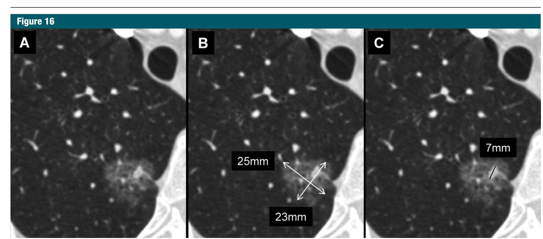 Transverse ct sections of a part-solid nodule in the right