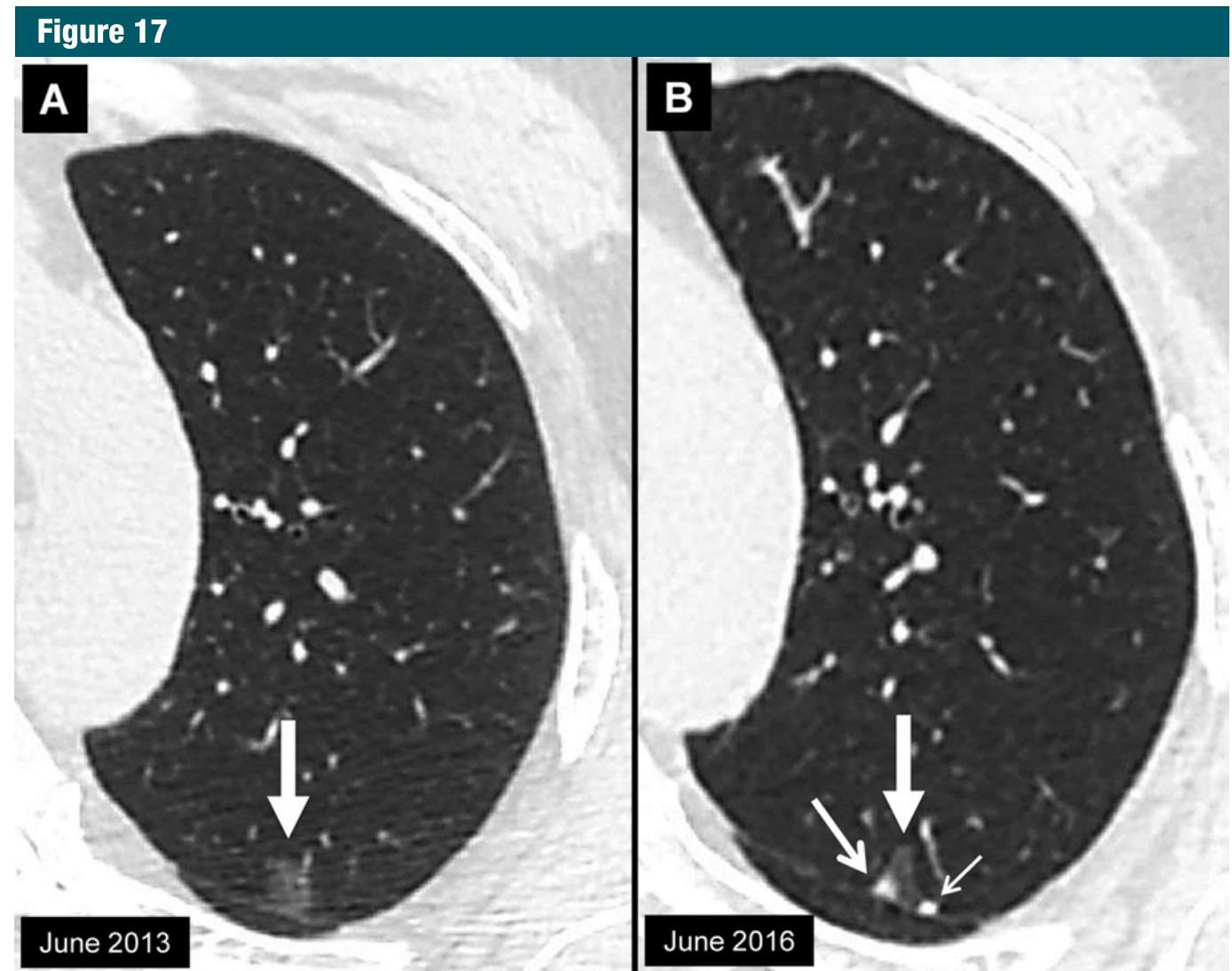 Transverse ct sections through a nodule (large arrow) in the