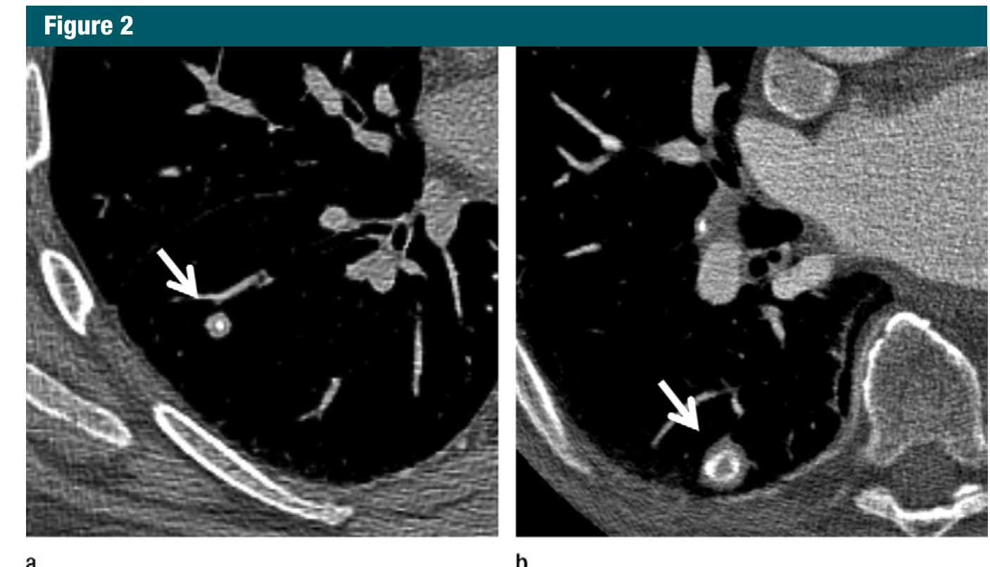 (PDF) Guidelines for Management of Incidental Pulmonary Nodules ...