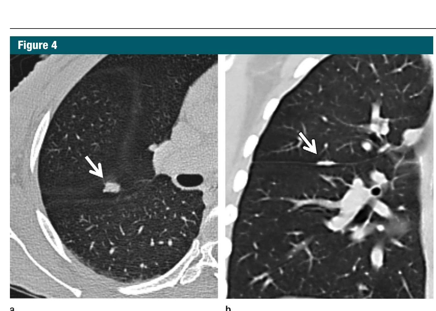 (a) transverse 1-mm ct section shows a nodular opacity