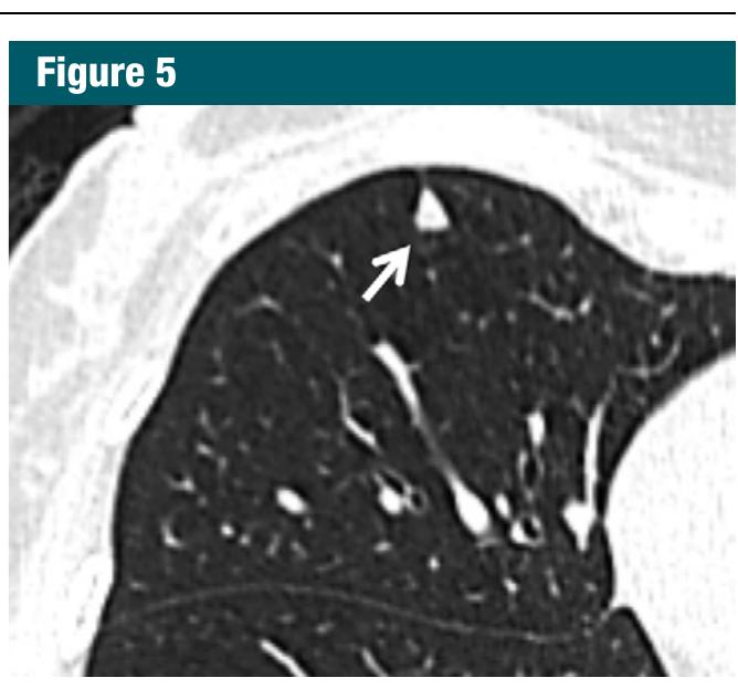 Ct image shows a solid triangular subpleural nodule (arrow)