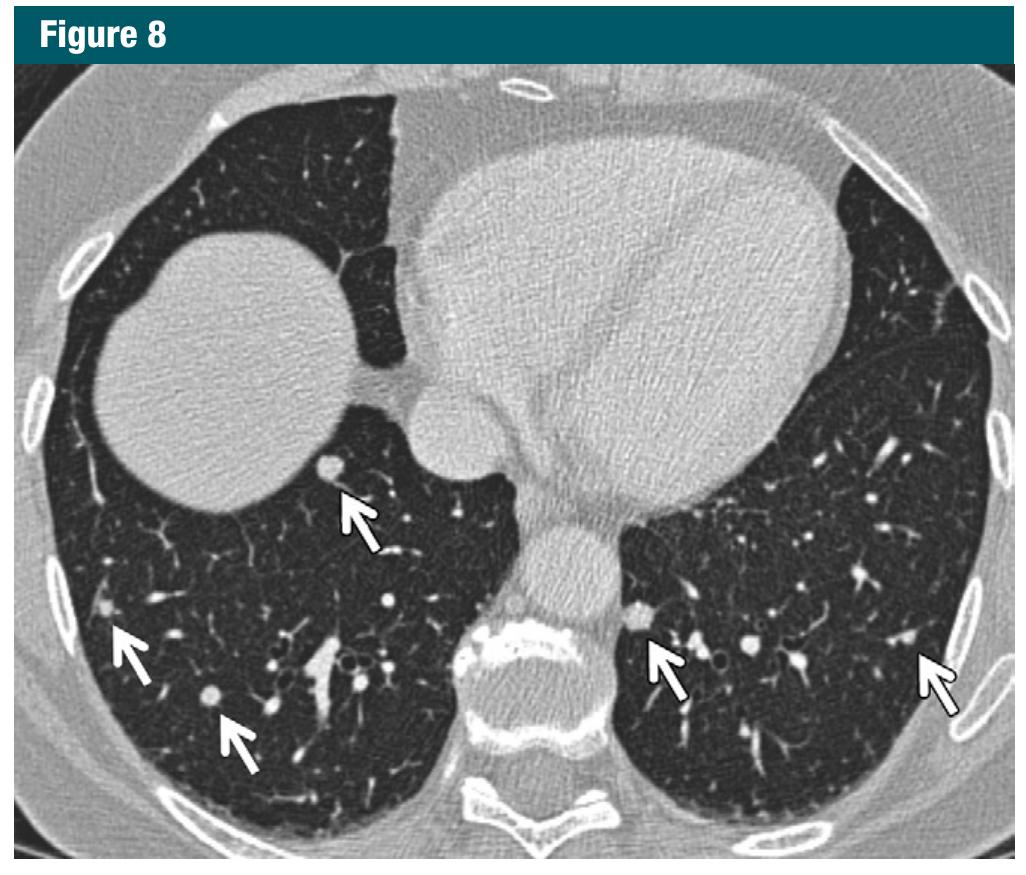 (PDF) Guidelines for Management of Incidental Pulmonary Nodules ...
